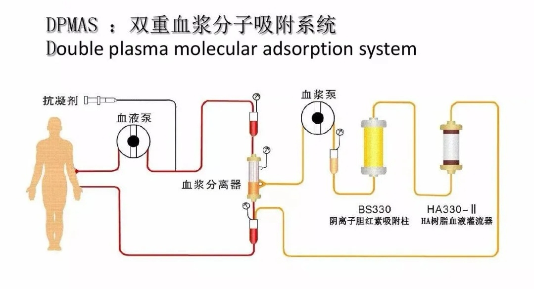 闸中心肾内科成功开展首例人工肝“双重血浆分子吸附系统（DPMAS）”治疗技术